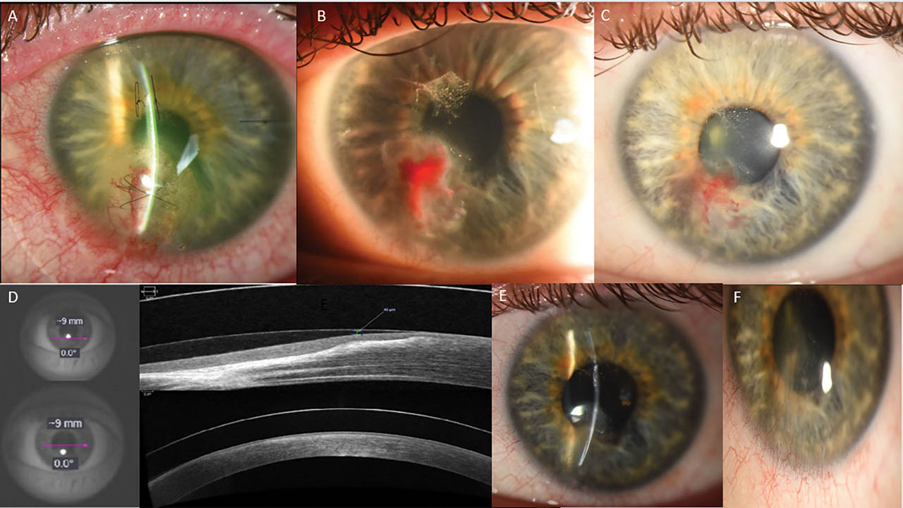 ONLINE EXCLUSIVE: Using MICE for KNV-Related Lipid Keratopathy ...