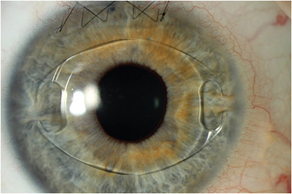 Corneal Physician | PentaVision