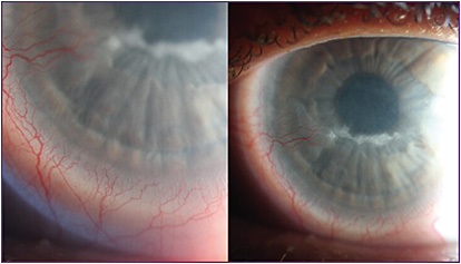 Corneal Physician | PentaVision