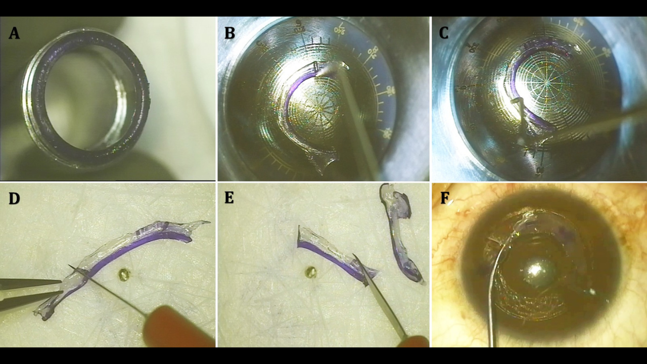 Corneal Allogenic Intrastromal Ring Segment Implantation for Post-Lasik ...