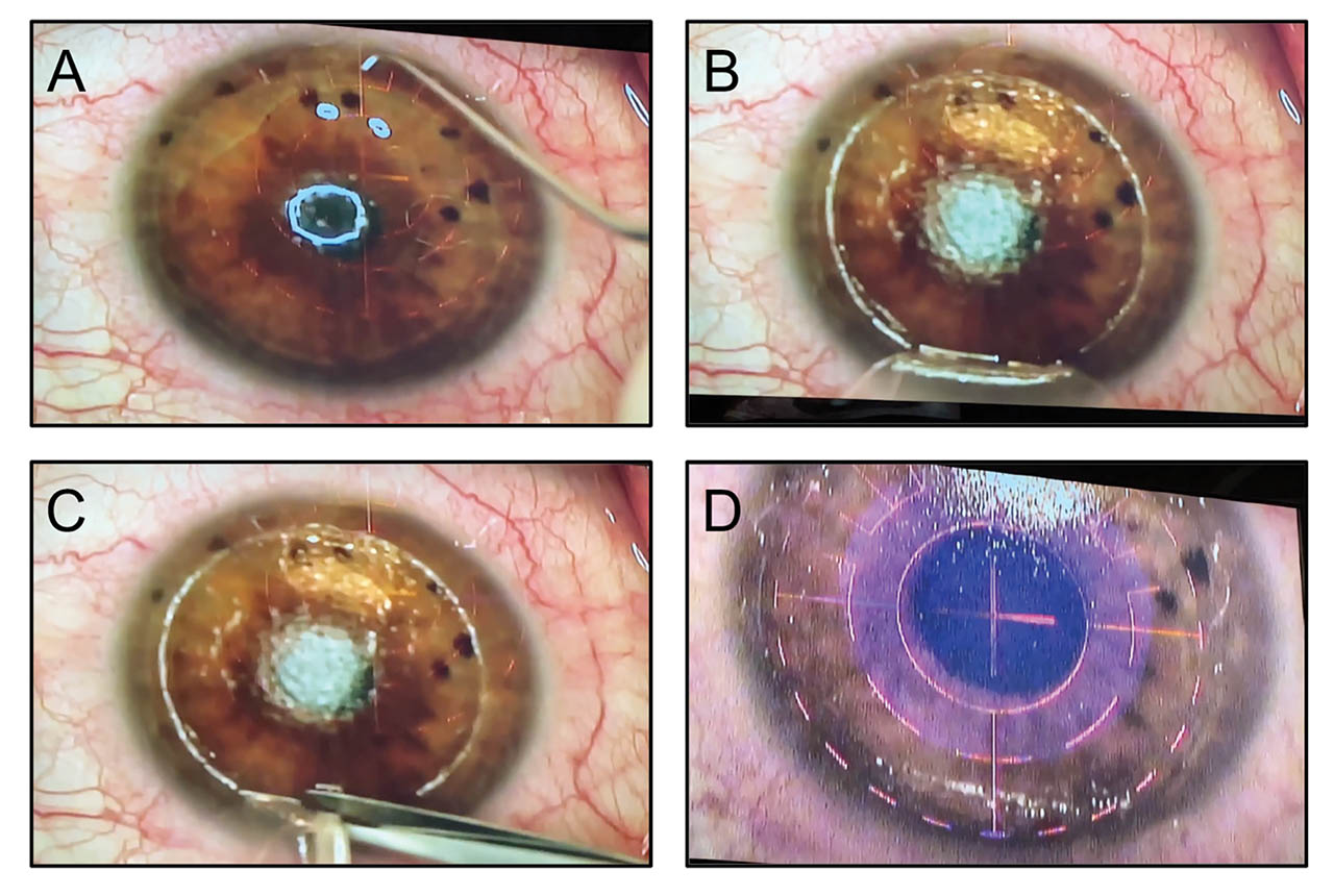 ONLINE EXCLUSIVE: Performing and Managing LASIK Flap Amputation ...