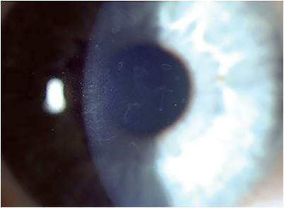 Corneal Physician | PentaVision