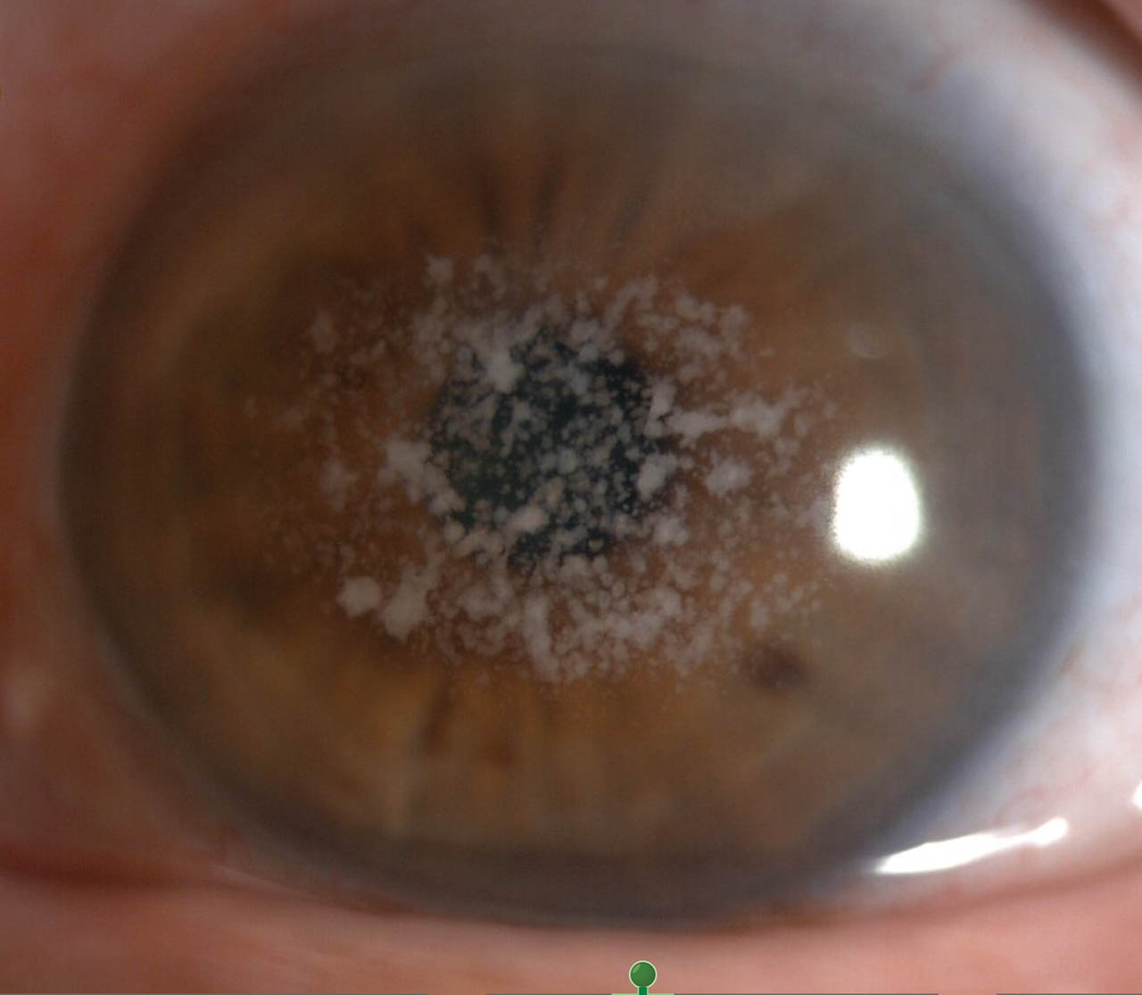 Schnyder Corneal Dystrophy