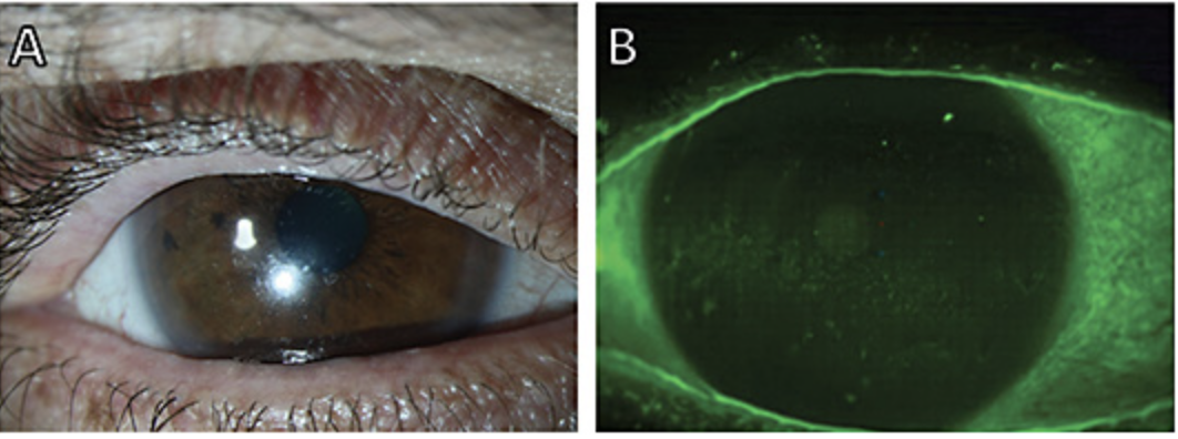 Corneal Physician | PentaVision