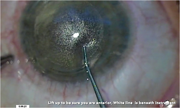 Corneal Physician | PentaVision