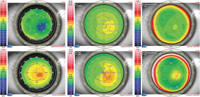 Corneal Physician | PentaVision