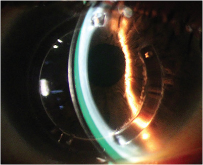 Corneal Physician | PentaVision