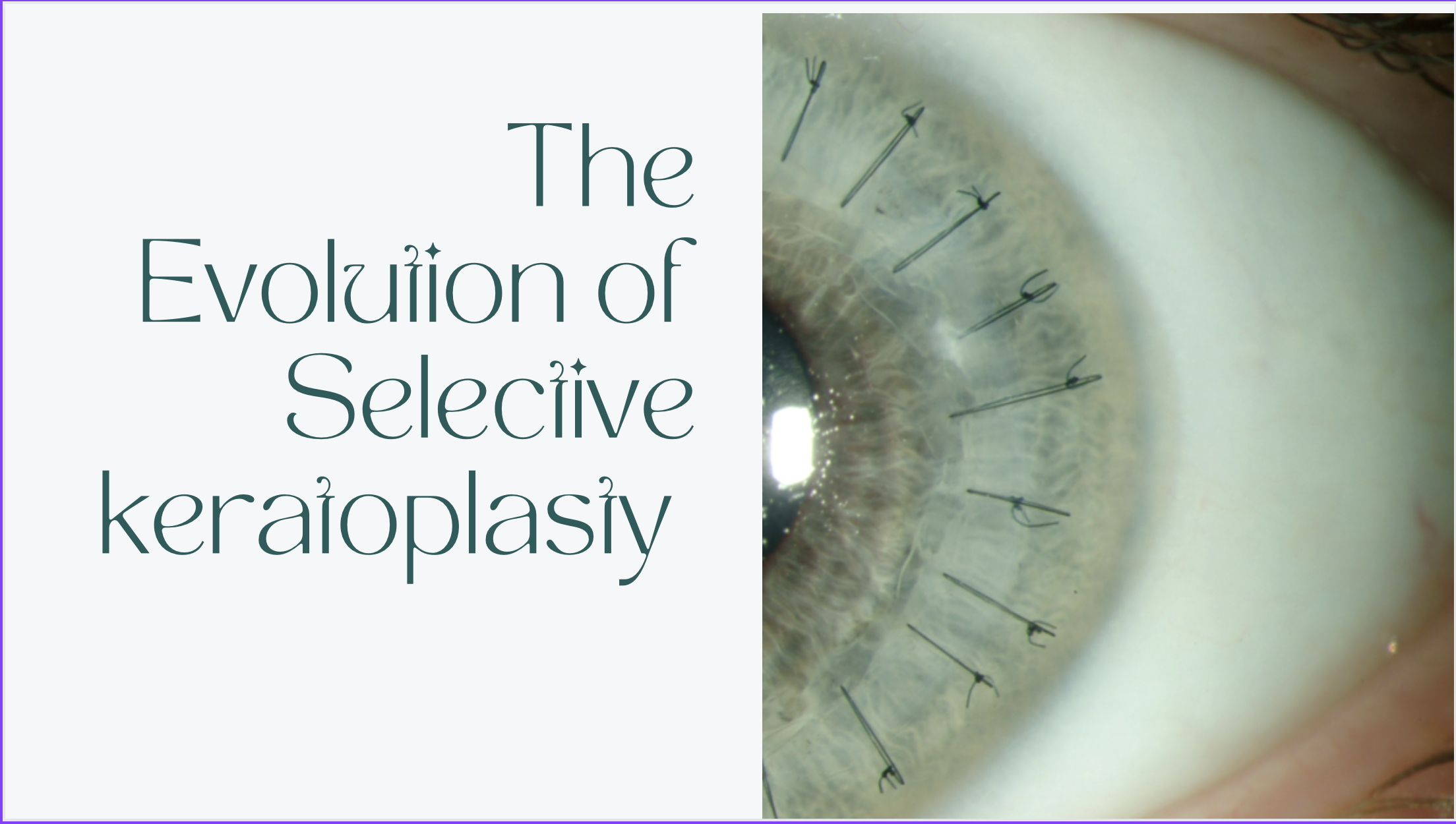 The Evolution of Selective Keratoplasty Techniques | Corneal Physician
