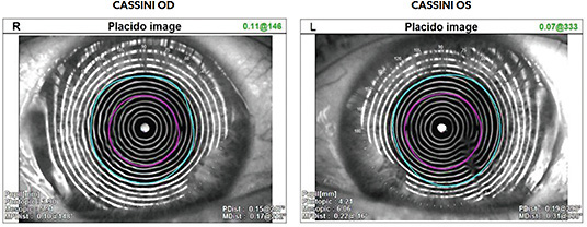 Corneal Physician | PentaVision